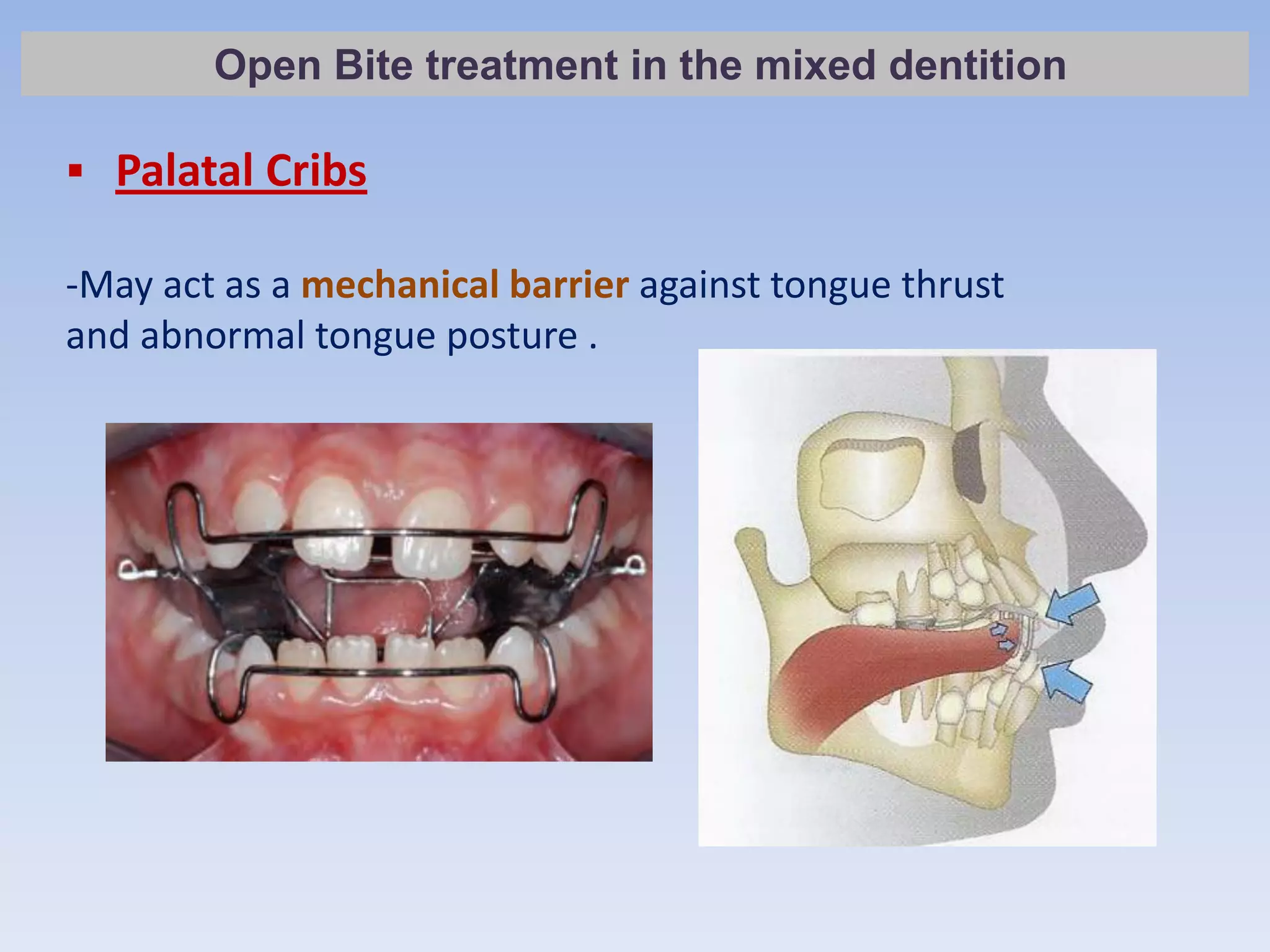 Anterior open bite treatment deciduous and mixed dentition .slide | PDF