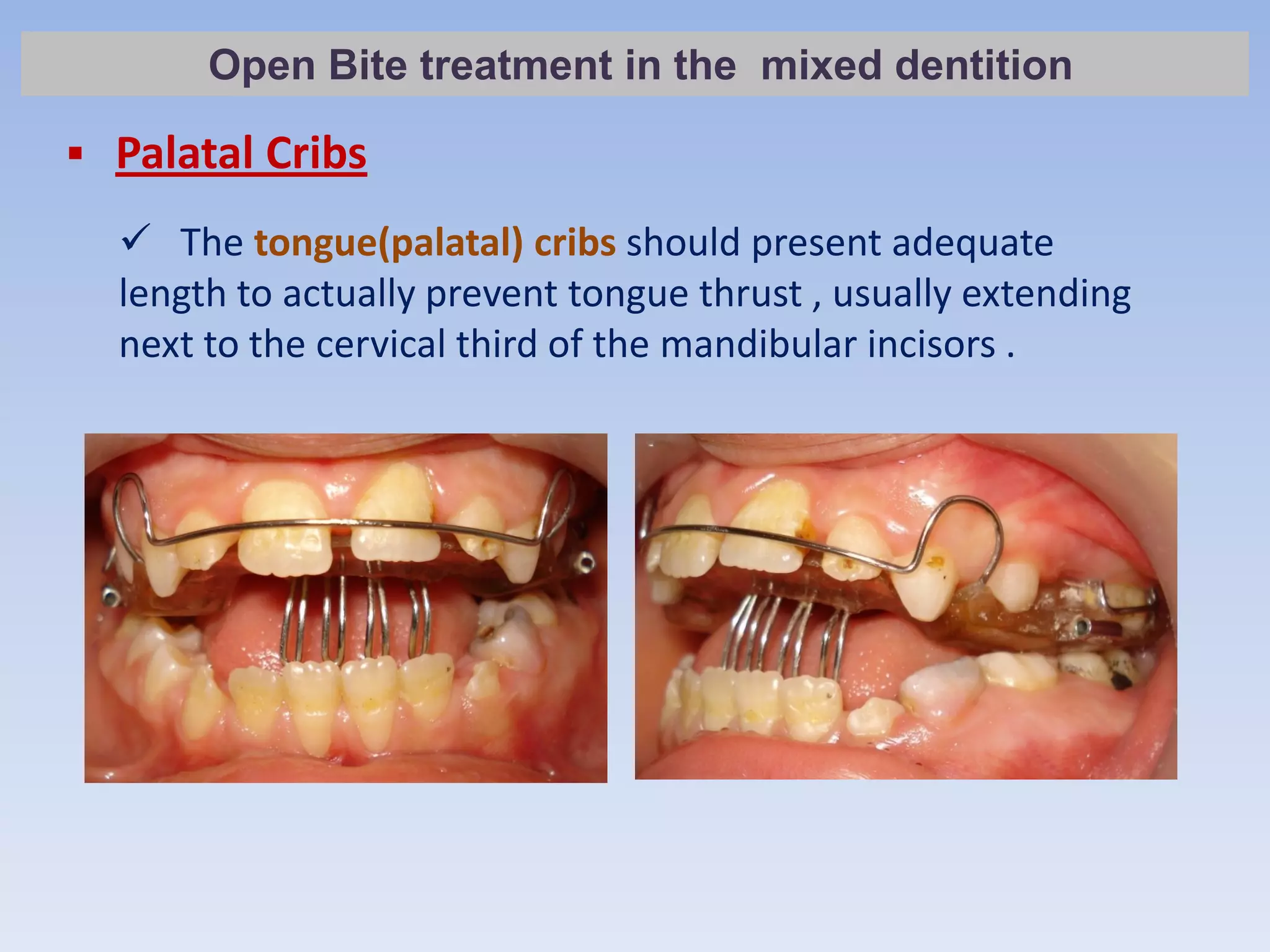 Anterior open bite treatment deciduous and mixed dentition .slide | PDF