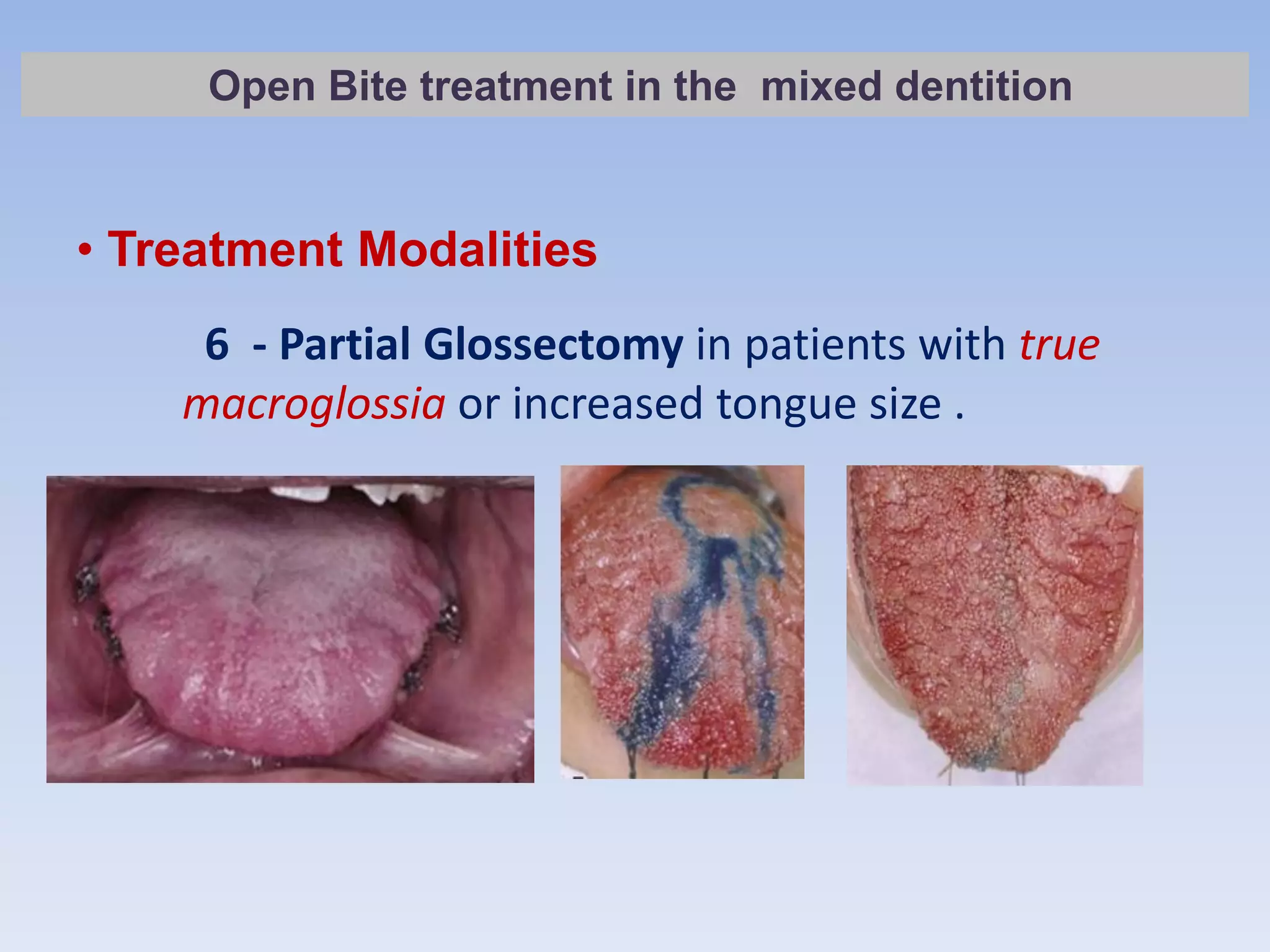 Anterior open bite treatment deciduous and mixed dentition .slide | PDF