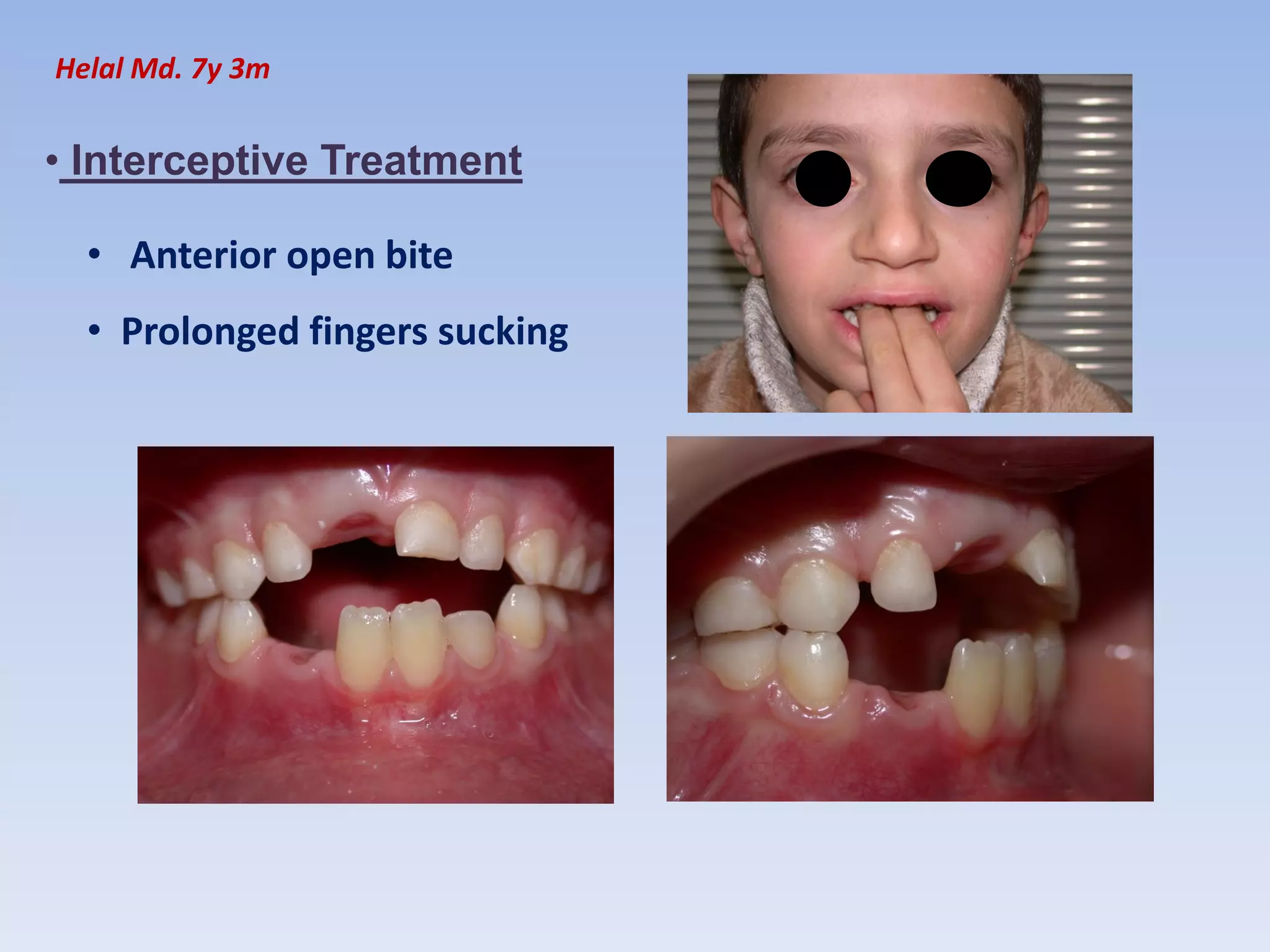 Anterior open bite treatment deciduous and mixed dentition .slide | PDF