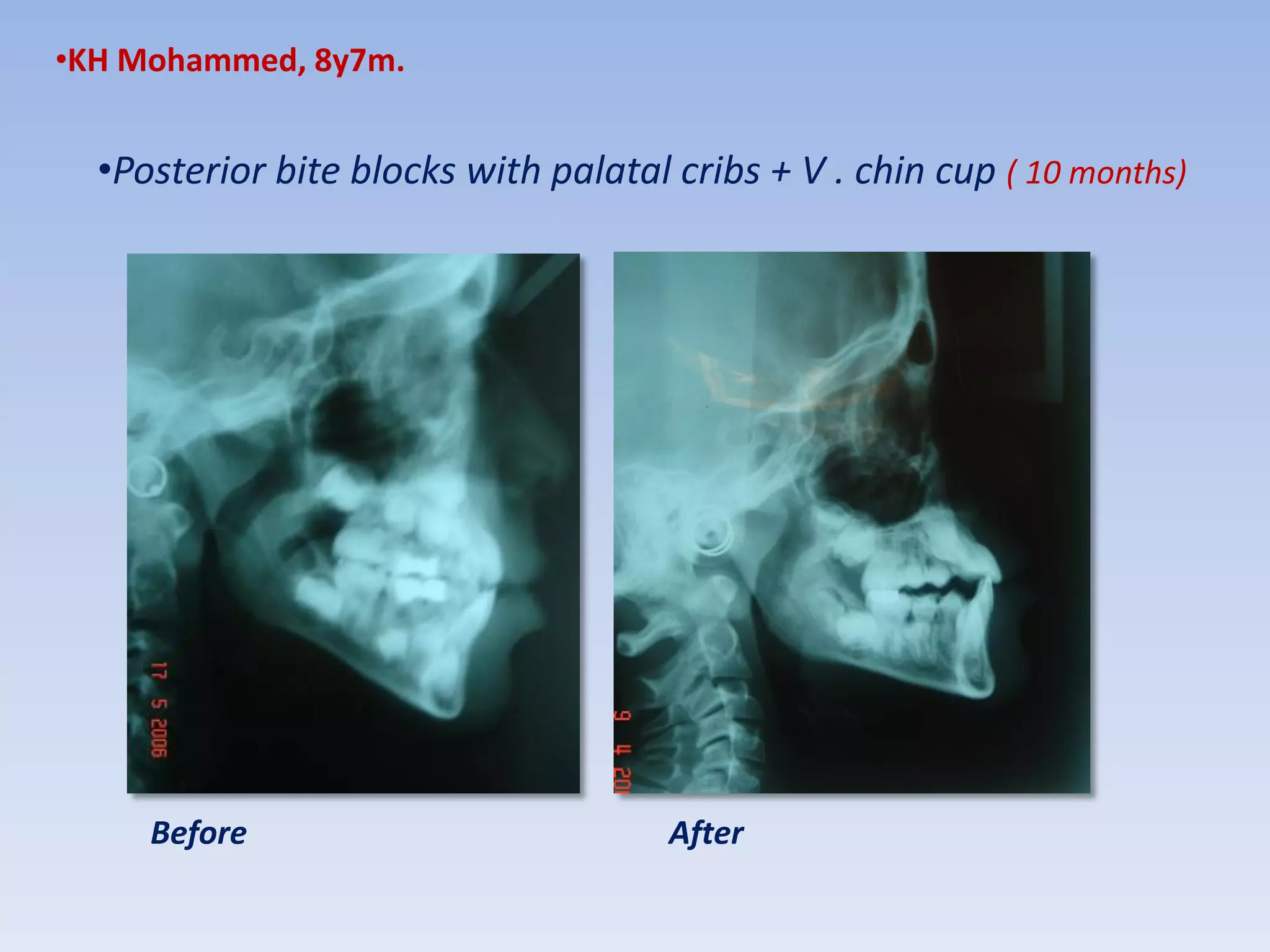 Anterior open bite treatment deciduous and mixed dentition .slide | PDF