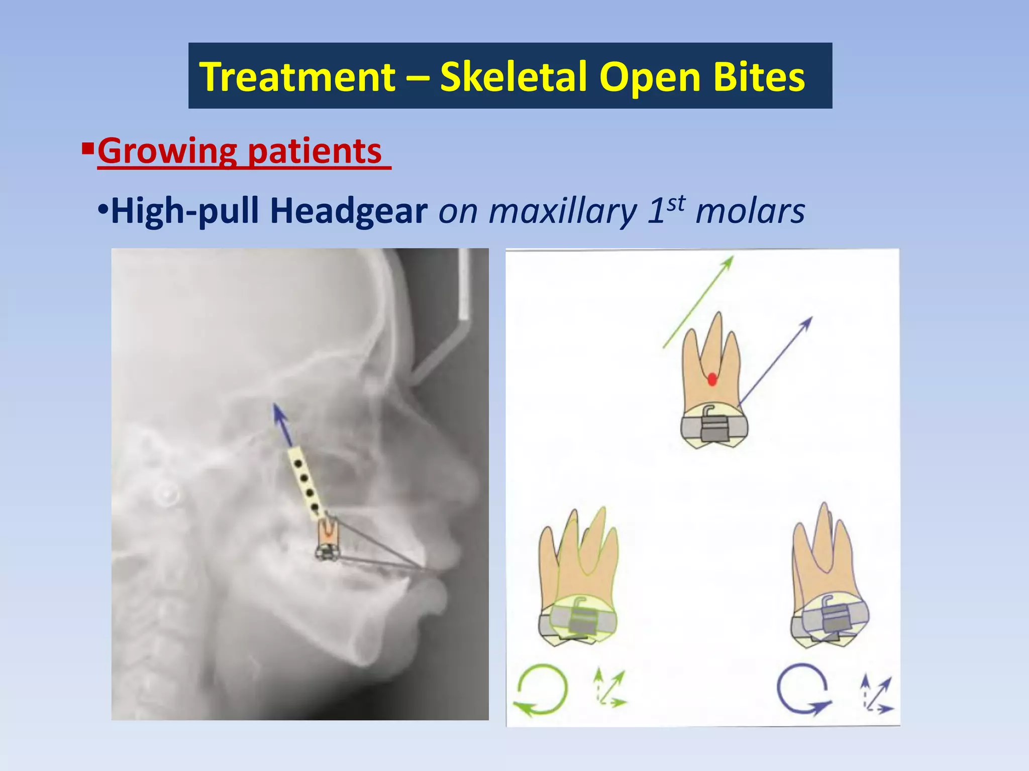 Anterior open bite treatment deciduous and mixed dentition .slide | PDF