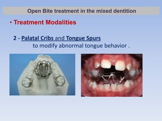 Anterior open bite treatment deciduous and mixed dentition .slide | PDF