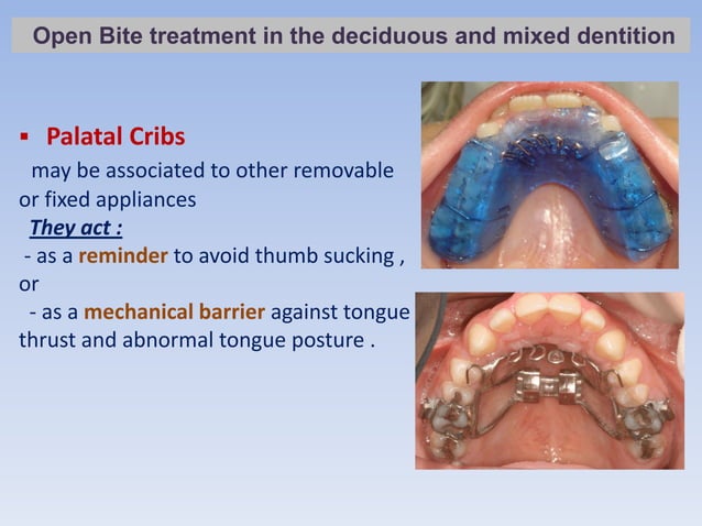 Anterior open bite treatment deciduous and mixed dentition .slide | PPT