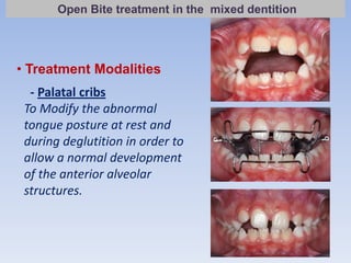 Anterior open bite treatment deciduous and mixed dentition .slide | PDF