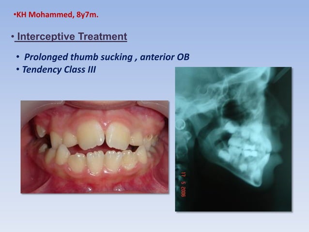 Anterior open bite treatment deciduous and mixed dentition .slide | PDF ...