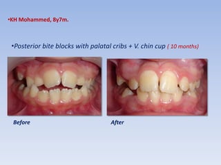 Anterior open bite treatment deciduous and mixed dentition .slide | PDF