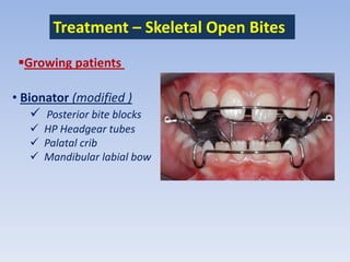 Anterior open bite treatment deciduous and mixed dentition .slide | PDF