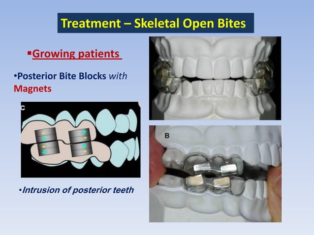 Anterior open bite treatment deciduous and mixed dentition .slide | PDF ...