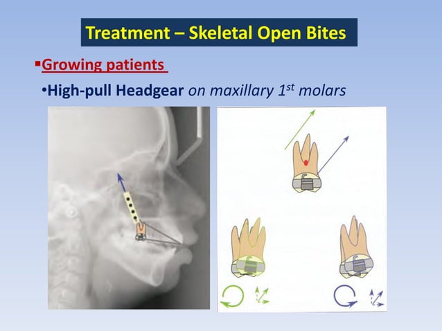 Anterior open bite treatment deciduous and mixed dentition .slide | PPT