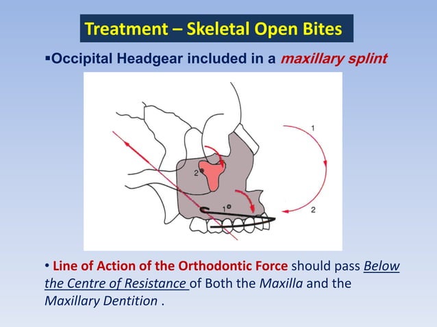 Anterior open bite treatment deciduous and mixed dentition .slide | PDF ...