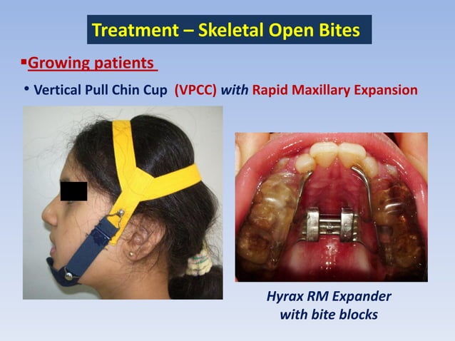 Anterior open bite treatment deciduous and mixed dentition .slide | PDF ...