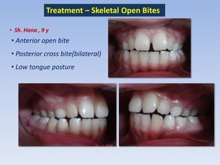 Anterior open bite treatment deciduous and mixed dentition .slide | PDF