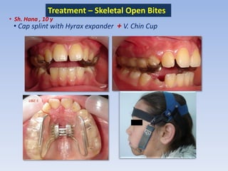 Anterior open bite treatment deciduous and mixed dentition .slide | PDF
