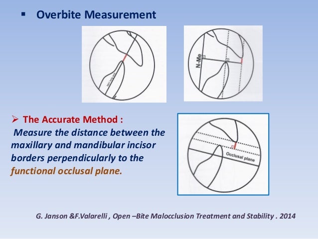 Anterior open bite treatment deciduous and mixed dentition .slide