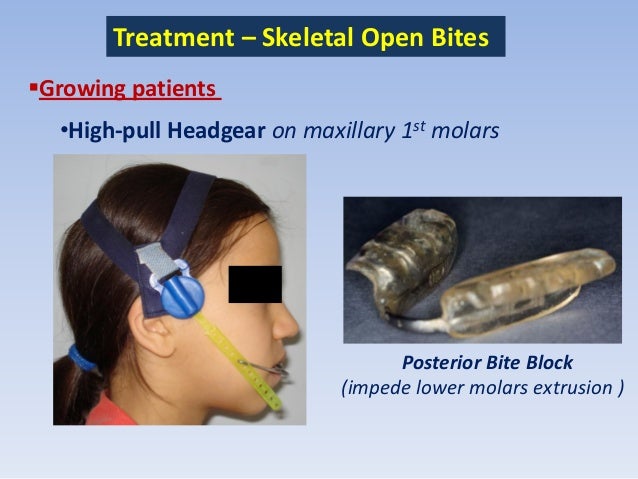 Anterior open bite treatment deciduous and mixed dentition .slide
