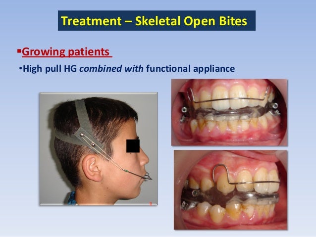 Anterior open bite treatment deciduous and mixed dentition .slide