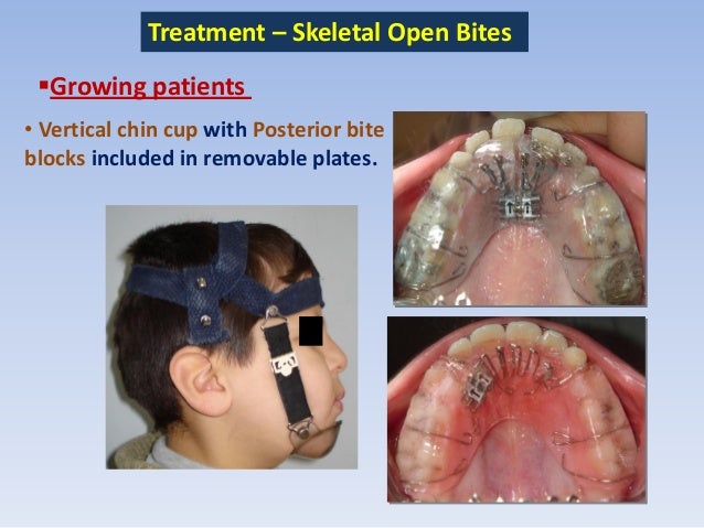 Anterior open bite treatment deciduous and mixed dentition .slide