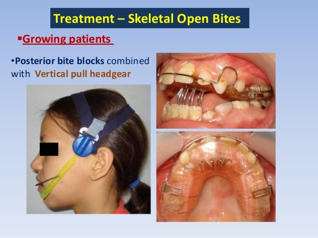 Anterior open bite treatment deciduous and mixed dentition .slide