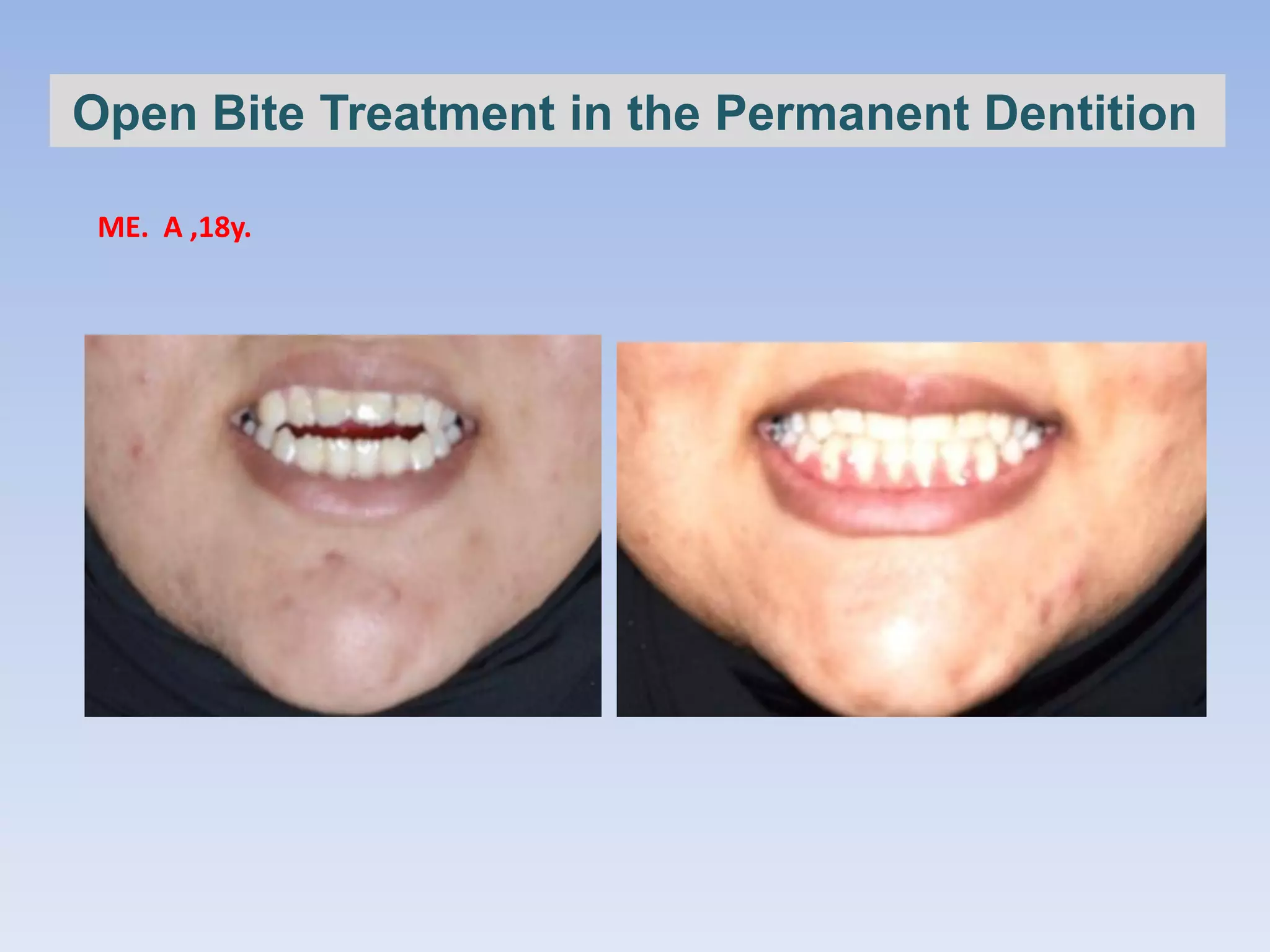 Anterior open bite treatment permanent dentition -1- .slide | PDF