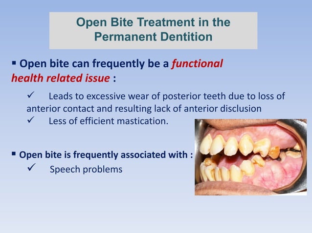 Anterior open bite treatment permanent dentition -1- .slide | PDF