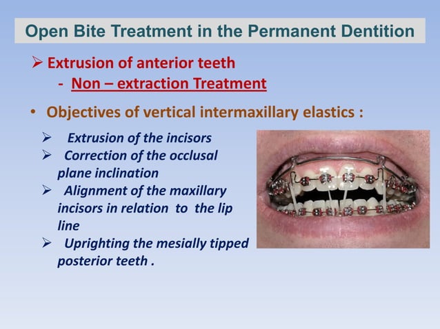 Anterior open bite treatment permanent dentition -1- .slide | PDF