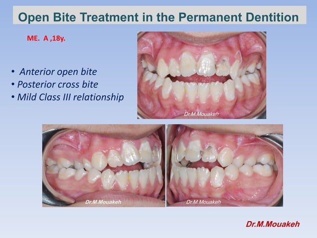 Anterior open bite treatment permanent dentition -1- .slide | PDF