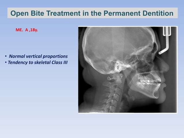 Anterior open bite treatment permanent dentition -1- .slide | PDF