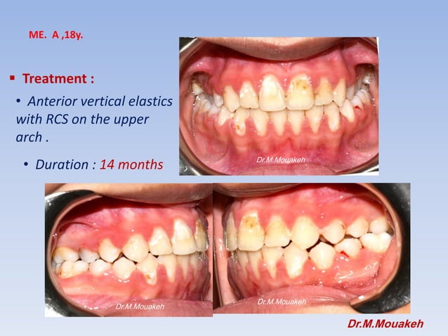 Anterior open bite treatment permanent dentition -1- .slide | PDF