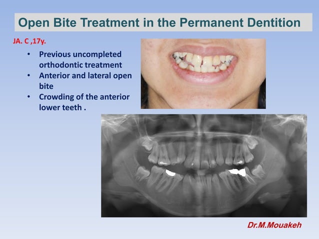 Anterior open bite treatment permanent dentition -1- .slide | PDF