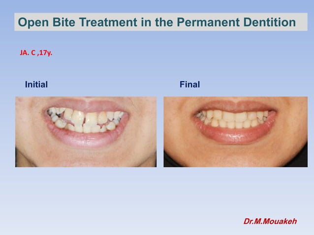 Anterior open bite treatment permanent dentition -1- .slide | PDF