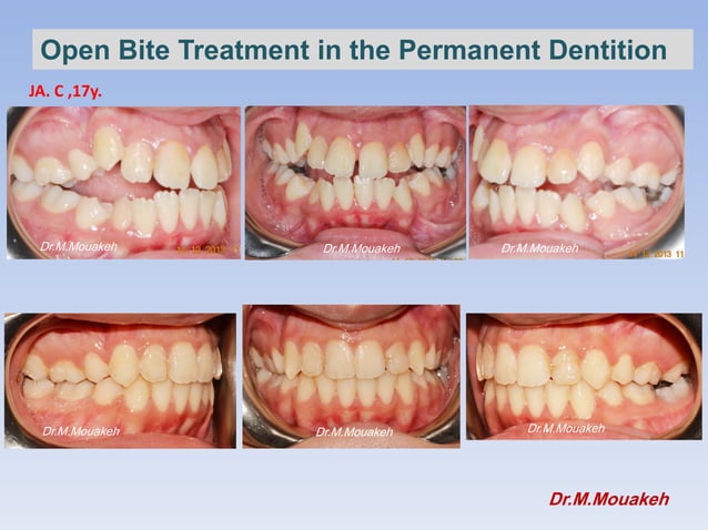 Anterior open bite treatment permanent dentition -1- .slide | PDF