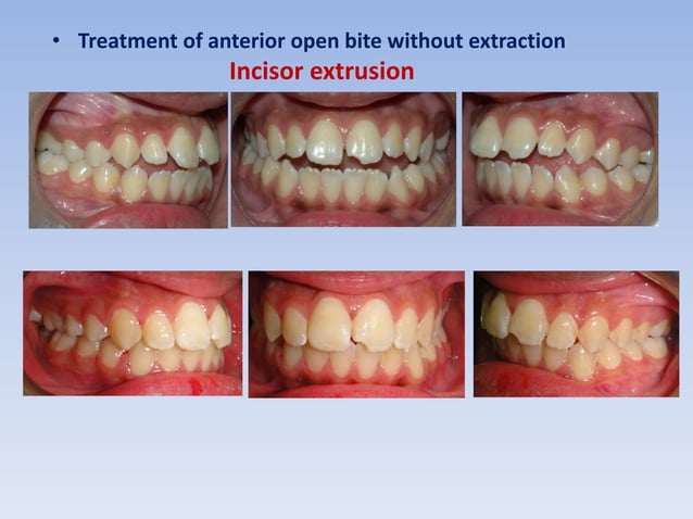 Anterior open bite treatment permanent dentition -1- .slide | PDF