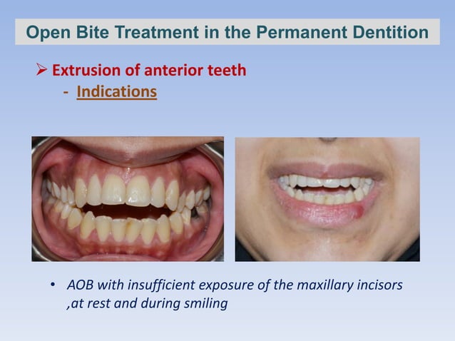 Anterior open bite treatment permanent dentition -1- .slide | PDF