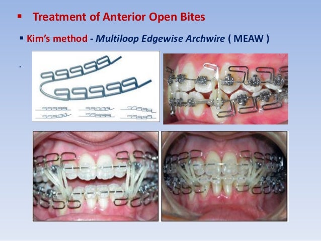 Anterior open bite treatment permanent dentition -1- .slide