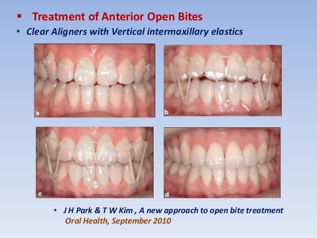 Anterior open bite treatment permanent dentition -1- .slide