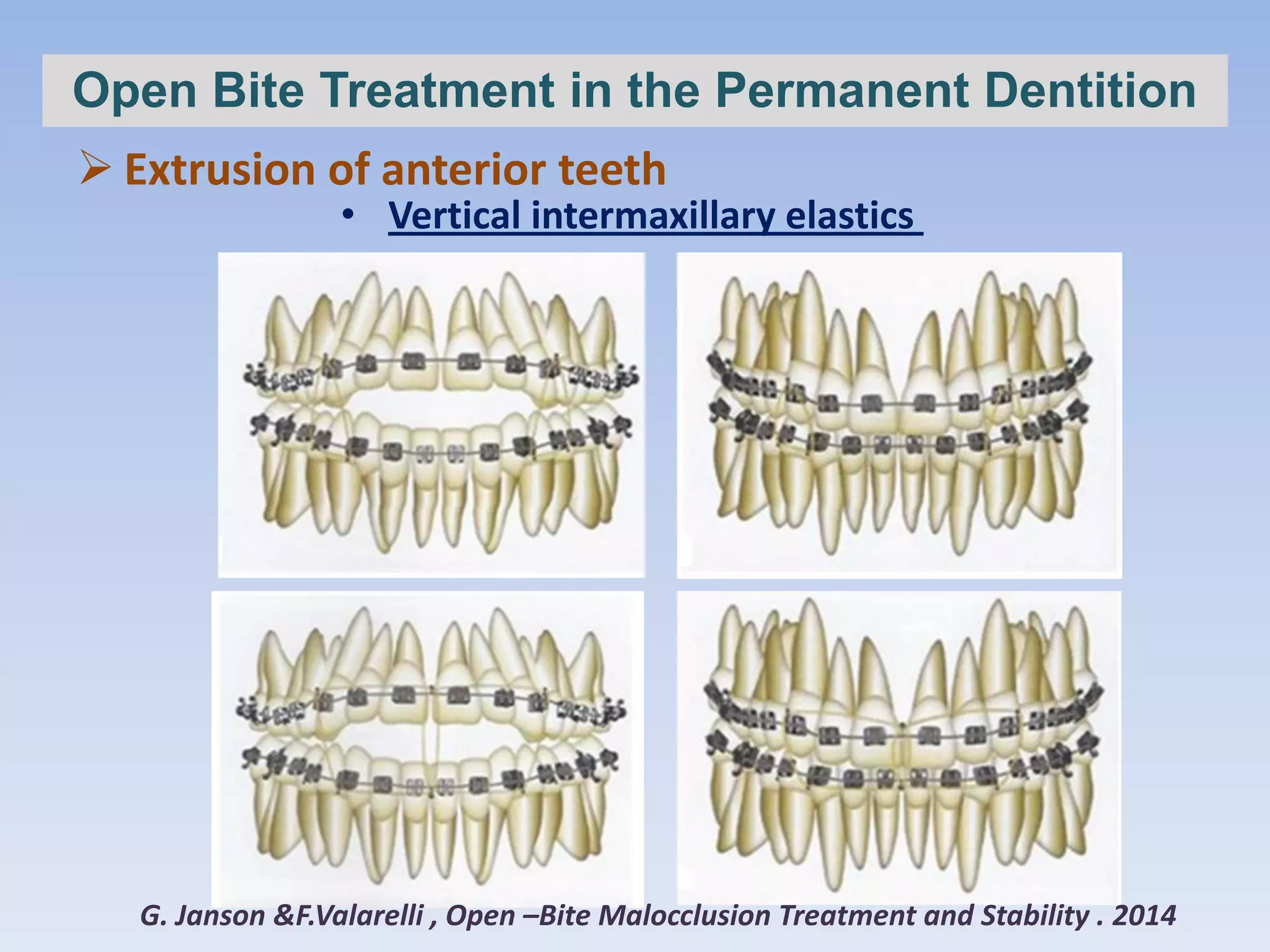 Anterior open bite treatment permanent dentition -1- .slide | PDF