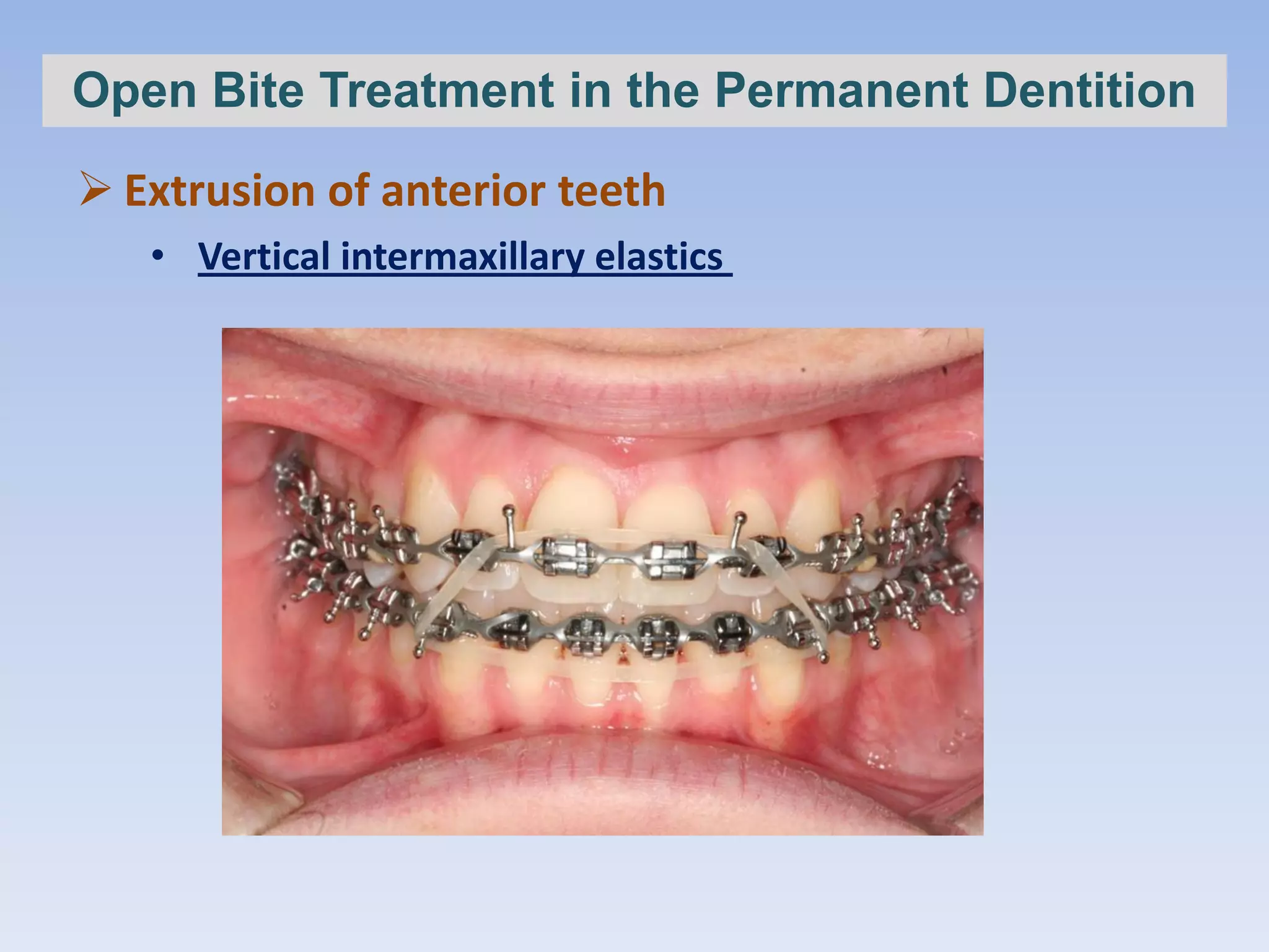Anterior open bite treatment permanent dentition -1- .slide | PDF