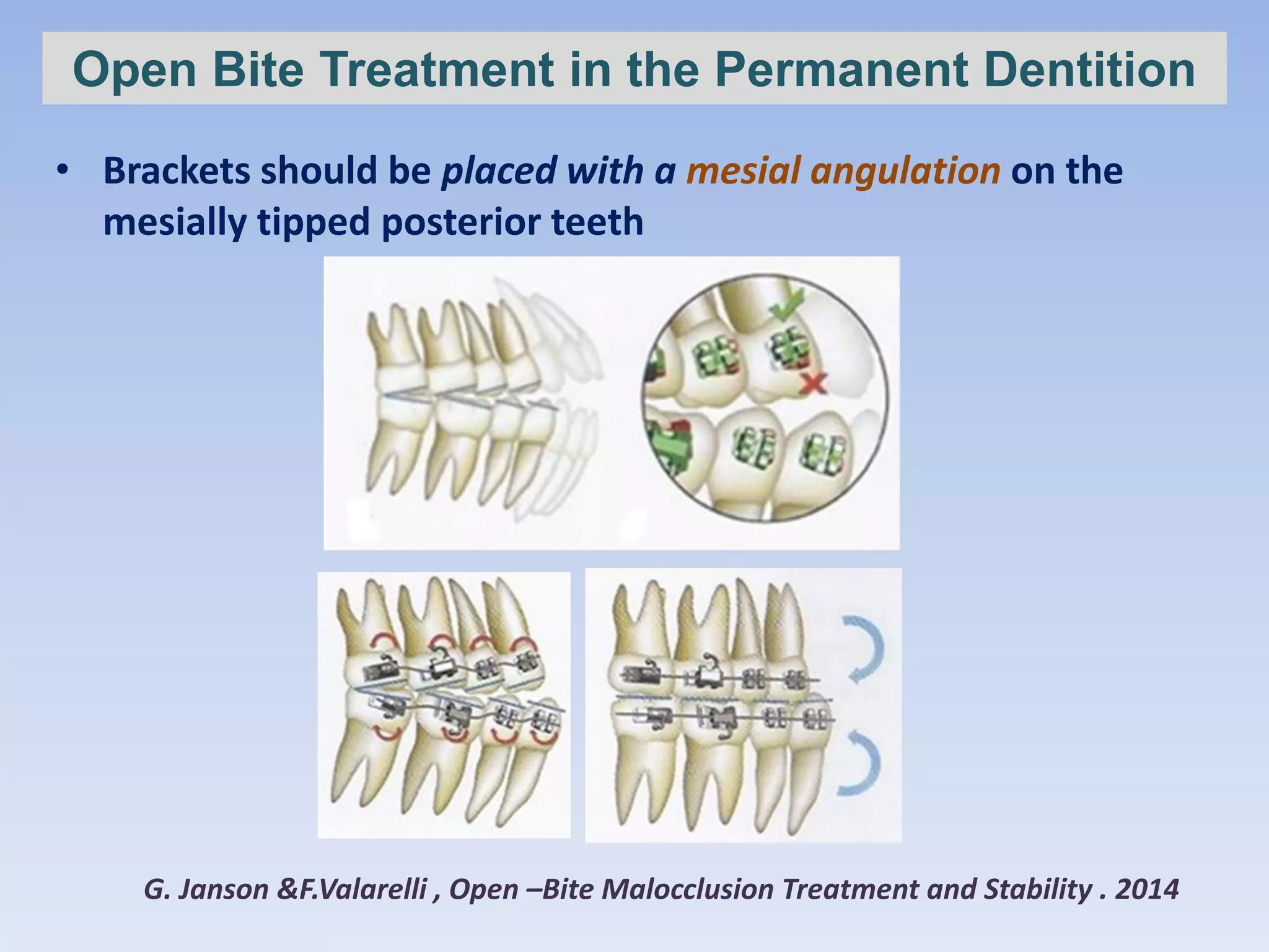 Anterior open bite treatment permanent dentition -1- .slide | PDF