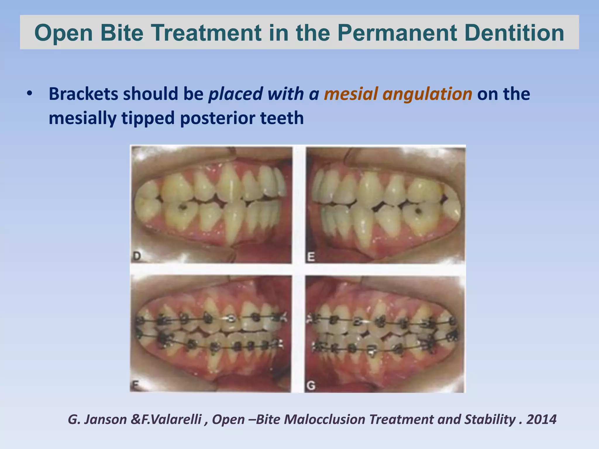 Anterior open bite treatment permanent dentition -1- .slide | PDF