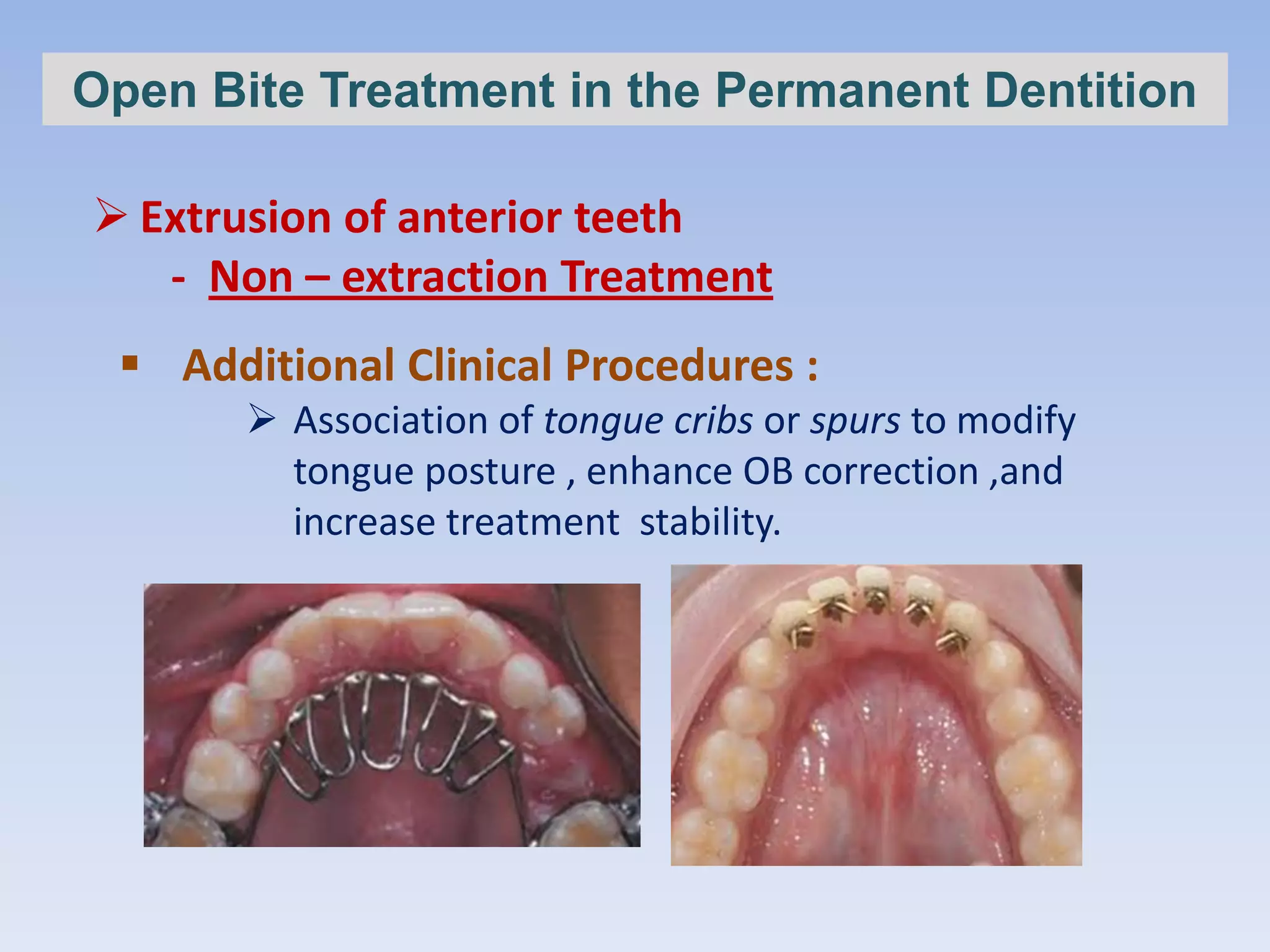 Anterior open bite treatment permanent dentition -1- .slide | PDF