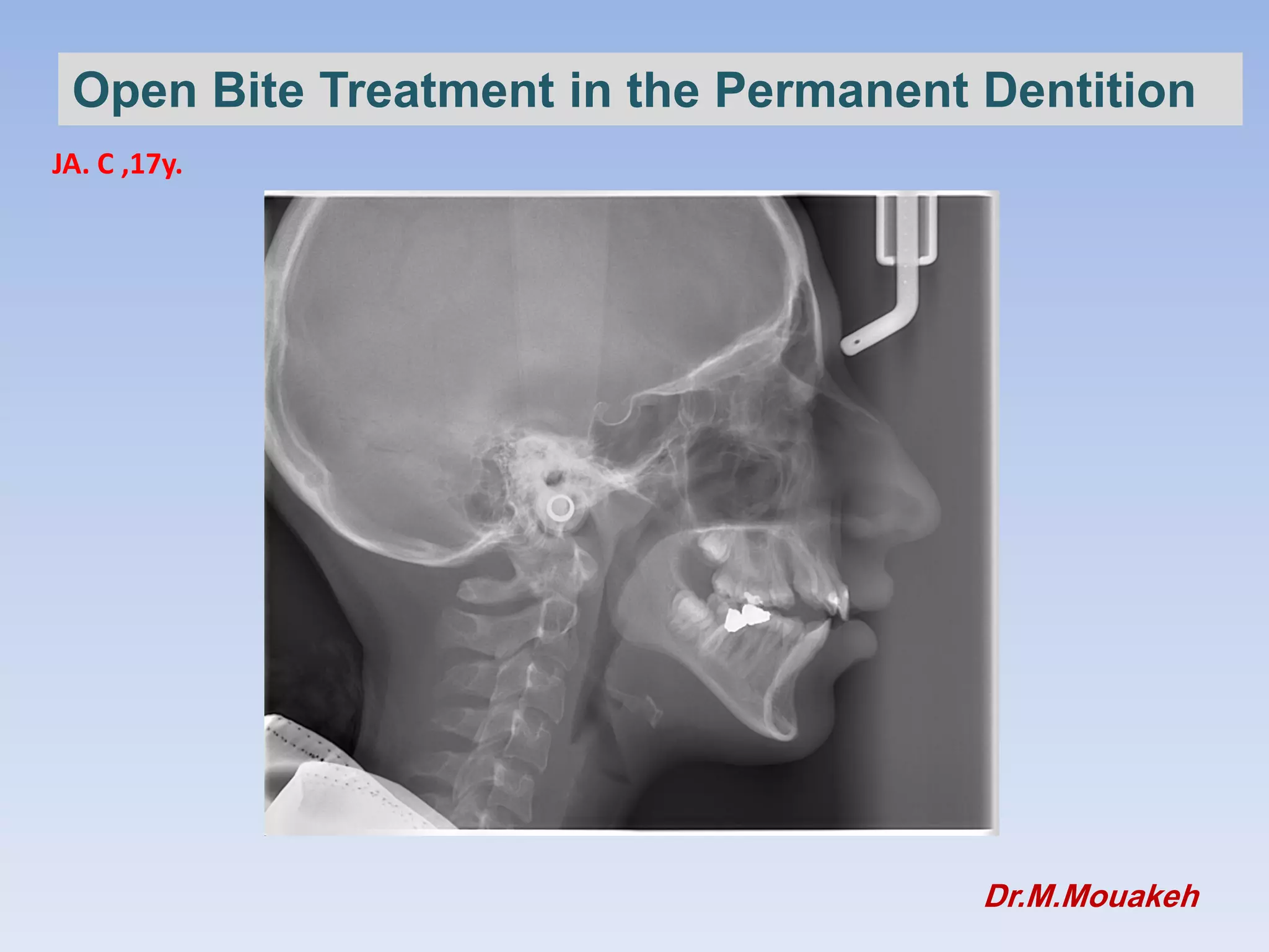 Anterior open bite treatment permanent dentition -1- .slide | PDF