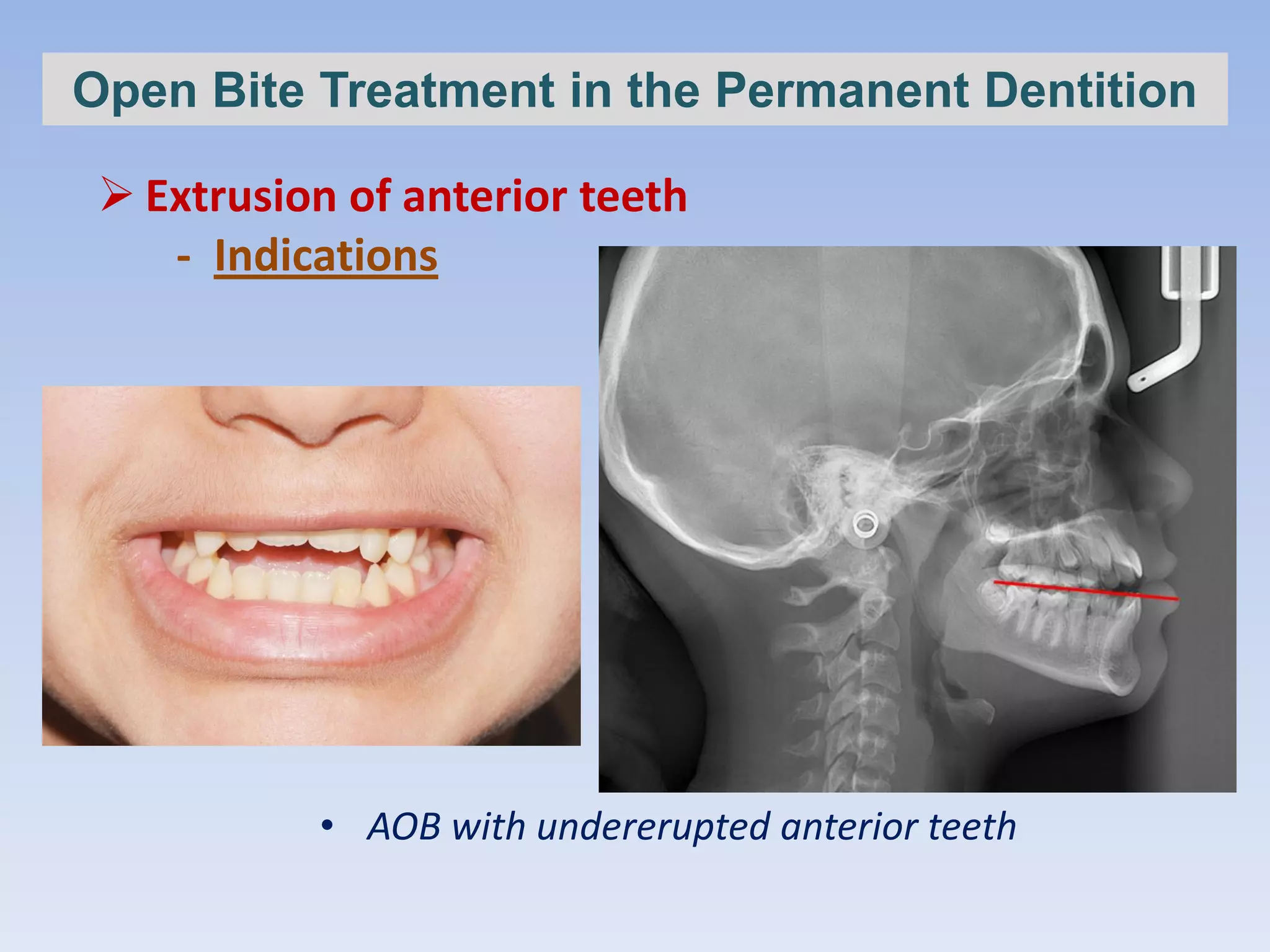 Anterior open bite treatment permanent dentition -1- .slide | PDF