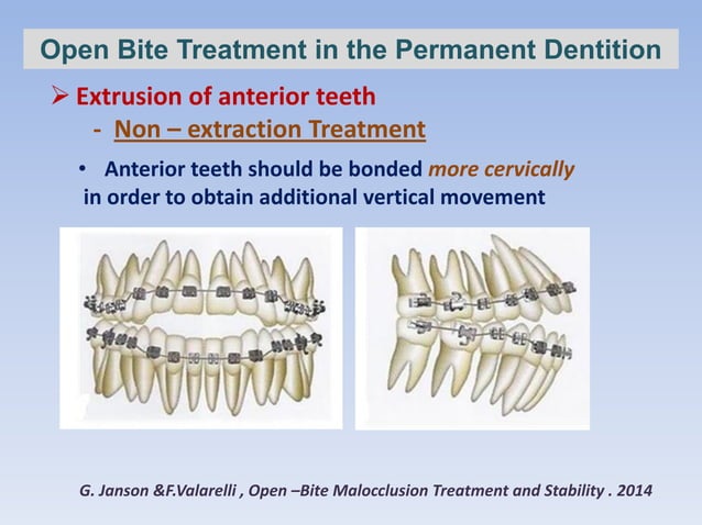 Anterior open bite treatment permanent dentition -1- .slide | PDF ...
