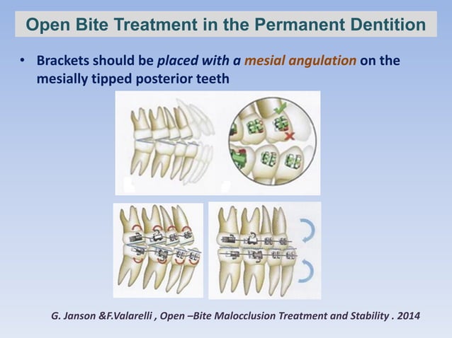 Anterior open bite treatment permanent dentition -1- .slide | PDF ...