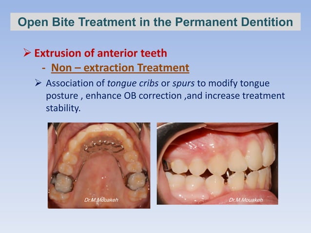 Anterior open bite treatment permanent dentition -1- .slide | PDF ...