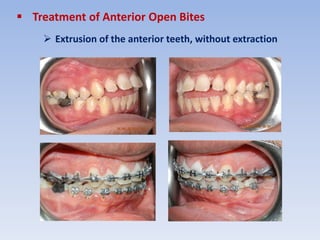 Anterior open bite treatment permanent dentition -1- .slide | PDF