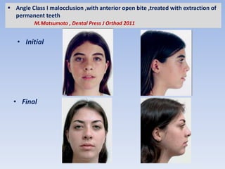 Anterior open bite treatment permanent dentition -1- .slide | PDF