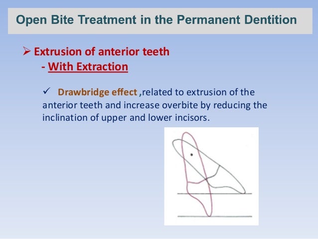 Thoughts on this 4 month plan?? : r/smiledirectclub