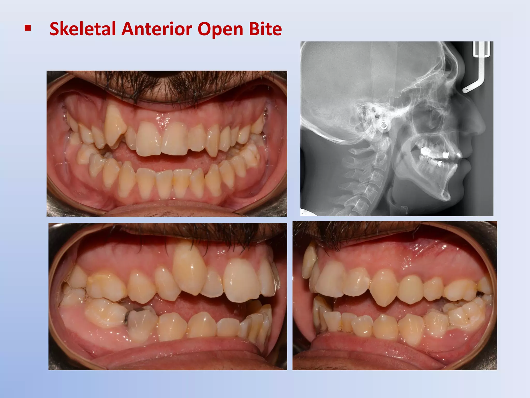 Anterior open bite treatment in the permanent dentition part 2- | PDF